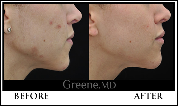 Icon Fractional Laser Weston & Fort Lauderdale, FL | Laser Skin ...
