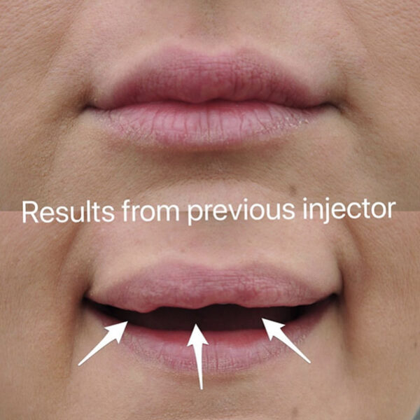 Lip Correction Case Study?