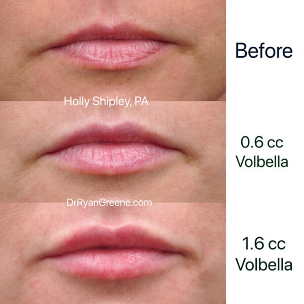 Juvederm Volbella Weston & Fort Lauderdale, FL | Lip Filler